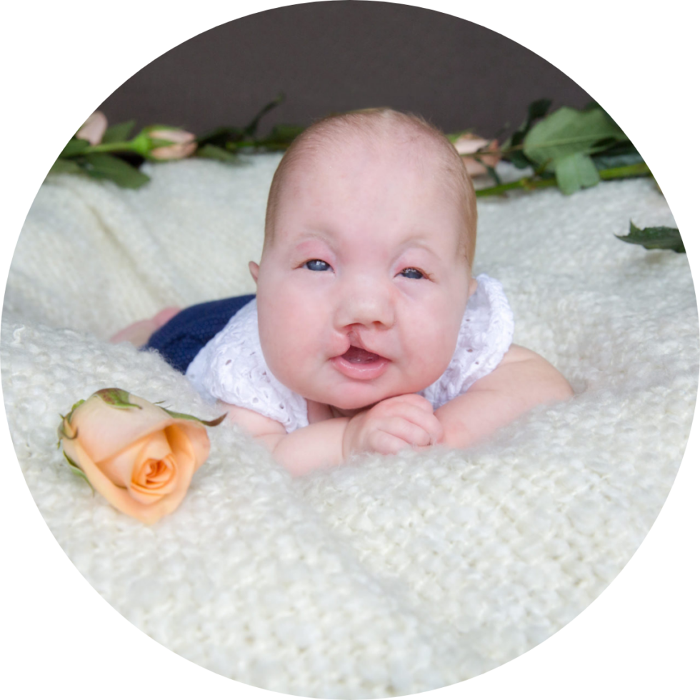 Support Organization for Trisomy | SOFT