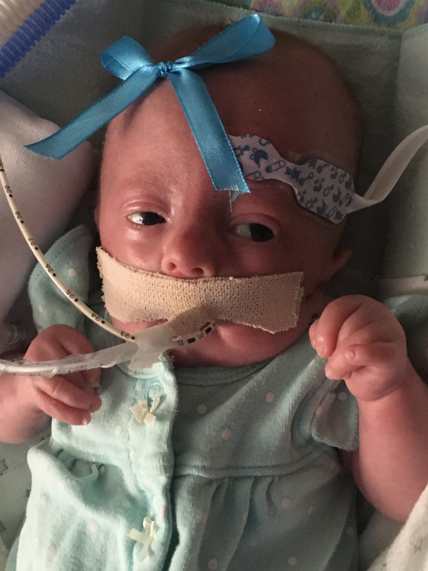 Madilyn F - Trisomy 18 | SOFT